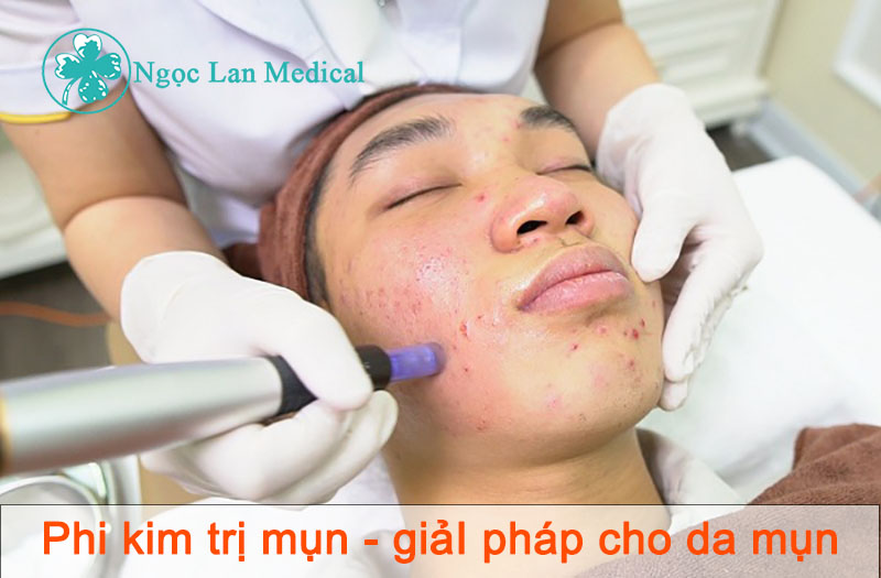 Phi kim trị mụn – giải pháp hiệu quả cho da mụn